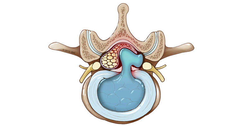 Extruded Disc Herniation - Discseel