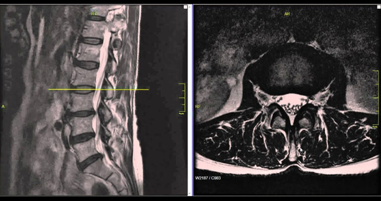 What is a Herniated Disc MRI? And When Might You Need One - Discseel