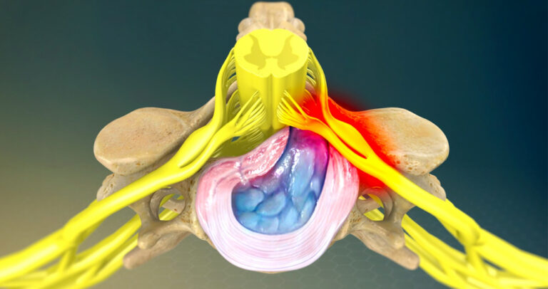 Is A Herniated Disc Able To Cause Permanent Nerve Damage? - Discseel
