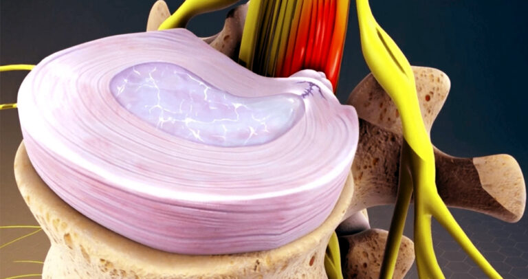 What is the Difference Between a Bulging Disc and a Herniated Disc ...