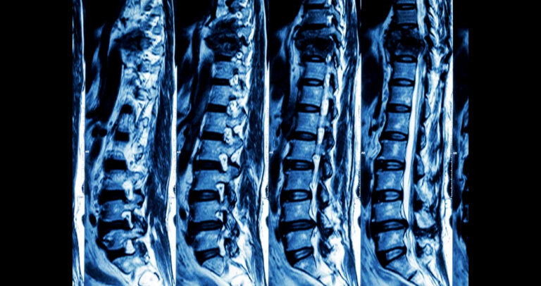 CT Scan Herniated Disc - Discseel